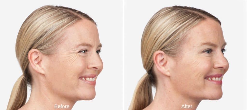 Botox Before and After | Westport, CT - New Beauty Wellness