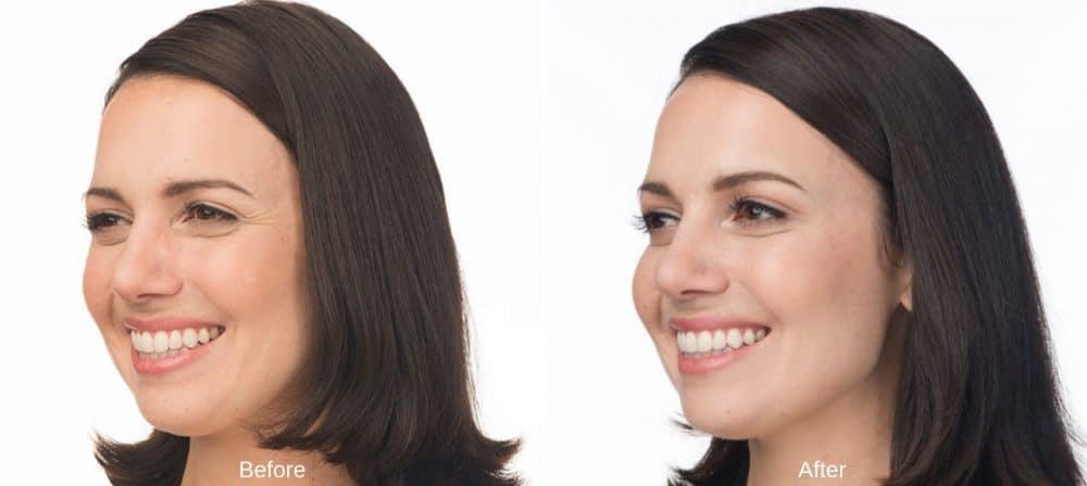 Botox Before and After | Westport, CT - New Beauty Wellness