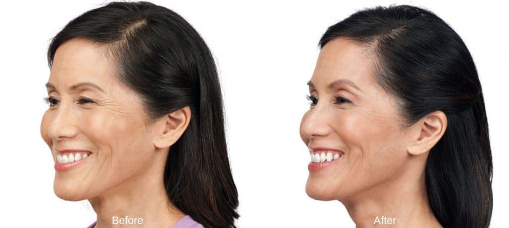 Botox Before and After | Westport, CT - New Beauty Wellness