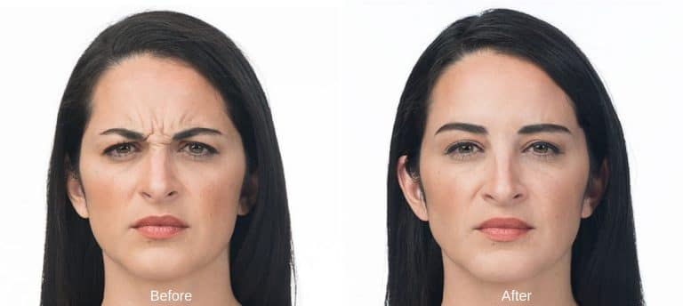 Botox Before and After | Westport, CT - New Beauty Wellness