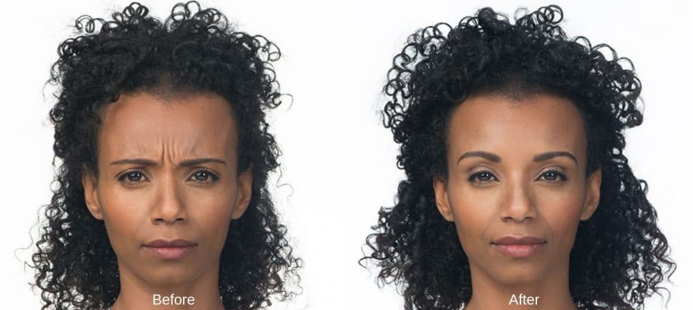 Botox Before and After | Westport, CT - New Beauty Wellness