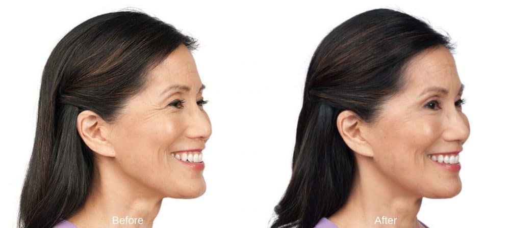 Botox Before and After | Westport, CT - New Beauty Wellness