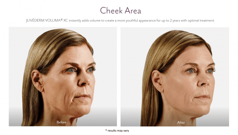 Juvederm Before and After Pictures | Juvederm Westport CT
