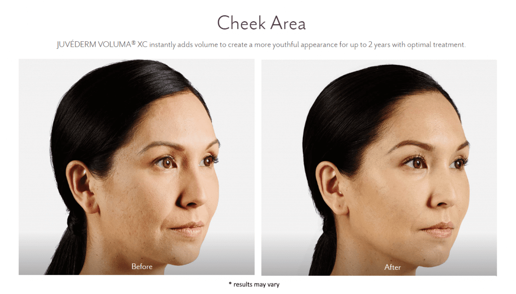 Juvederm Before and After Pictures | Juvederm Westport CT