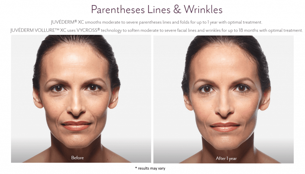 Juvederm Before and After Pictures | Juvederm Westport CT