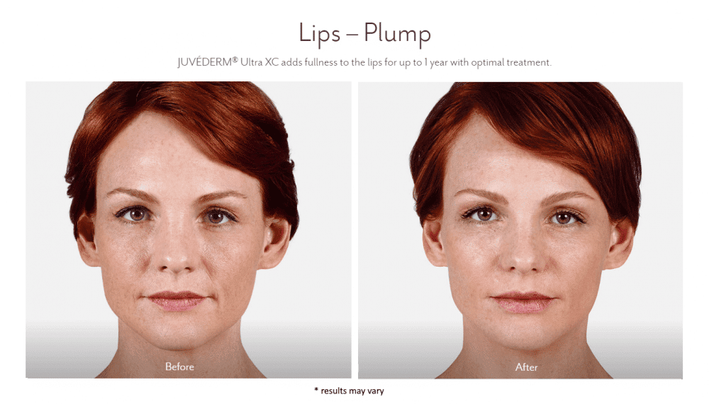 Juvederm Before and After Pictures | Juvederm Westport CT