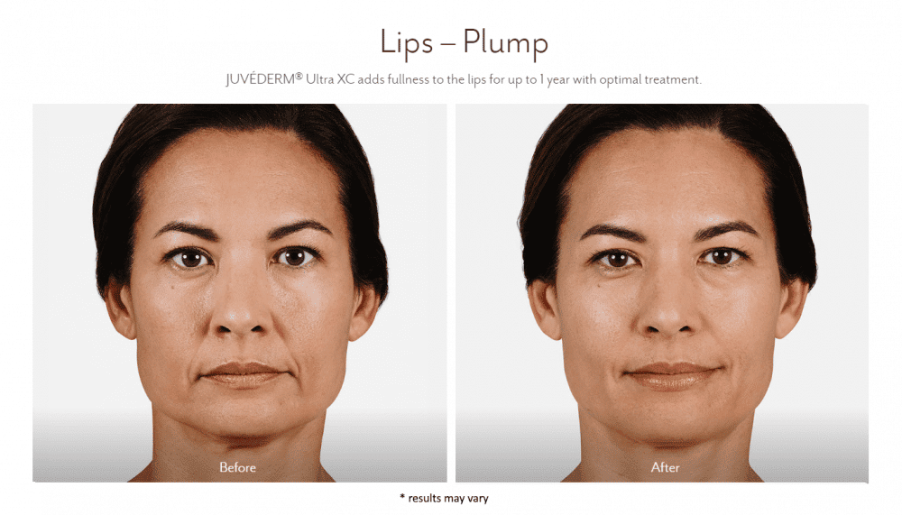 Juvederm Before and After Pictures | Juvederm Westport CT