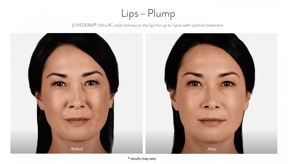Juvederm Before and After Pictures | Juvederm Westport CT