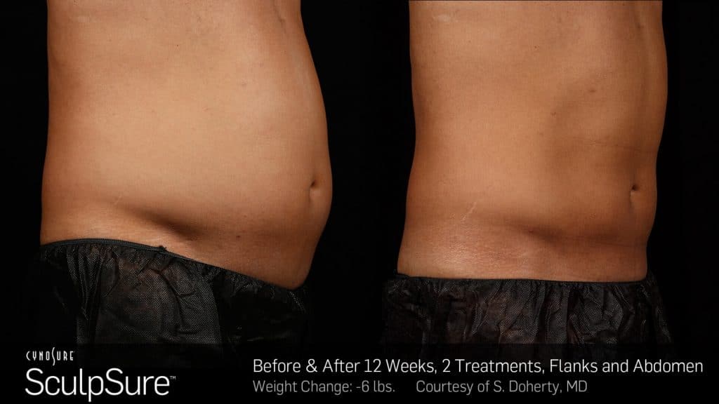 SculpSure before and after Photos: Real Patient Results - New Beauty ...
