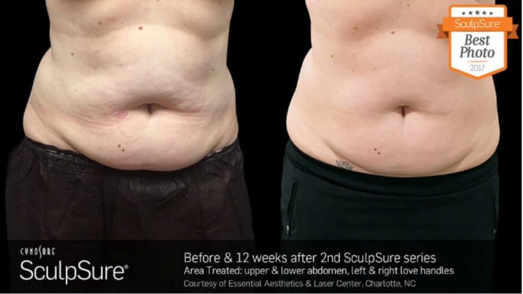 SculpSure before and after Photos: Real Patient Results - New Beauty Wellness