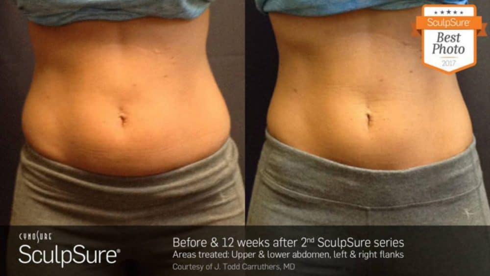 SculpSure before and after Photos: Real Patient Results - New Beauty Wellness