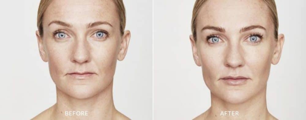 Restylane Filler at New Beauty and Wellness