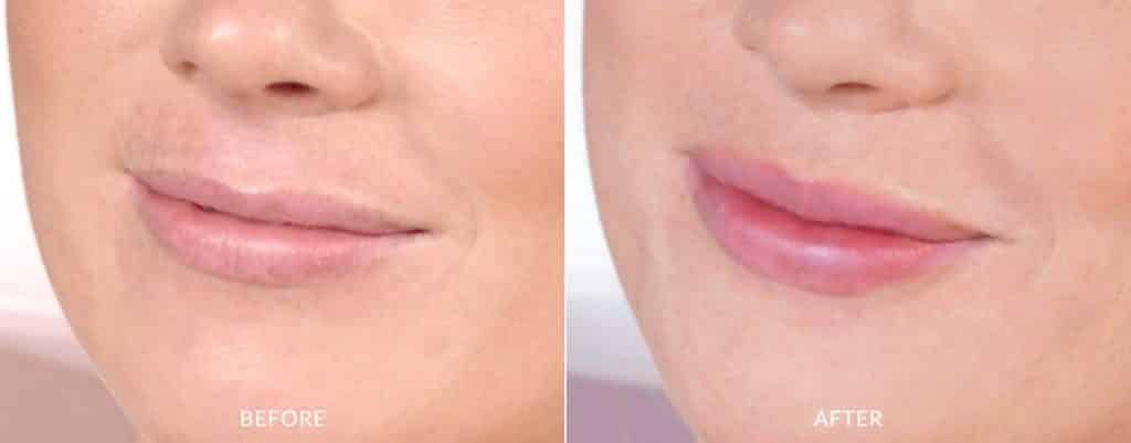 Restylane Lips at New Beauty and Wellness