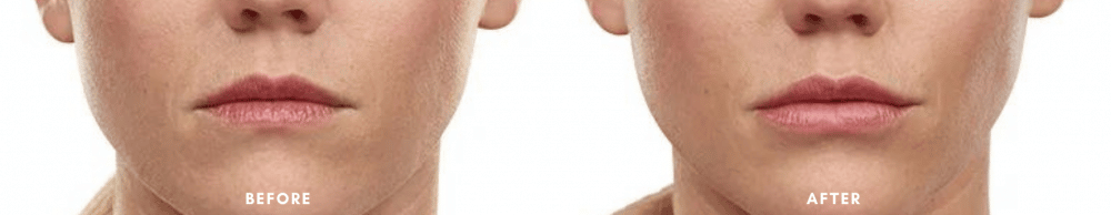 Lip Filler Healing Process Day-by-Day: A Timeline of What to Expect