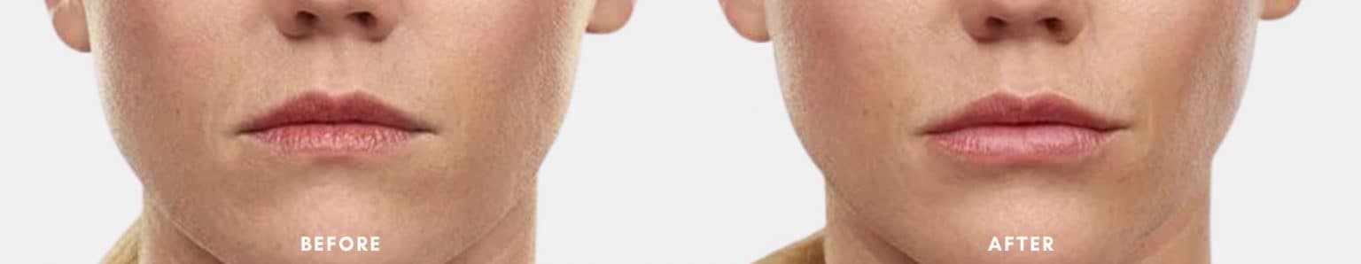 Lip Filler Healing Process Day-by-Day: A Timeline of What to Expect