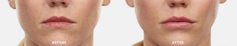 Lip Filler Healing Process Day-by-Day: A Timeline of What to Expect