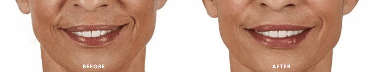 Lip Filler Healing Process Day-by-Day: A Timeline of What to Expect