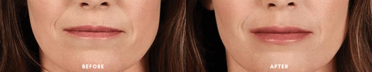 Lip Filler Healing Process Day-by-Day: A Timeline of What to Expect