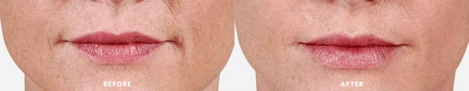 Lip Filler Healing Process Day-by-Day: A Timeline of What to Expect