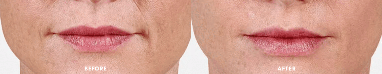 Lip Filler Healing Process Day-by-Day: A Timeline of What to Expect