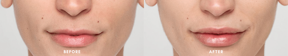 Lip Filler Healing Process Day-by-Day: A Timeline of What to Expect