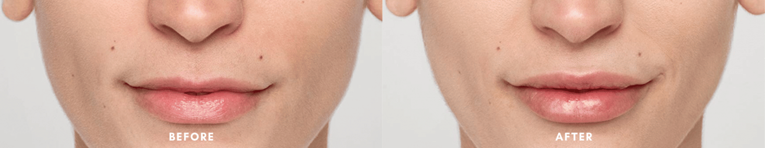 Lip Filler Healing Process Day-by-Day: A Timeline of What to Expect