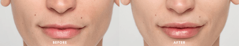 Lip Filler Healing Process Day-by-Day: A Timeline of What to Expect