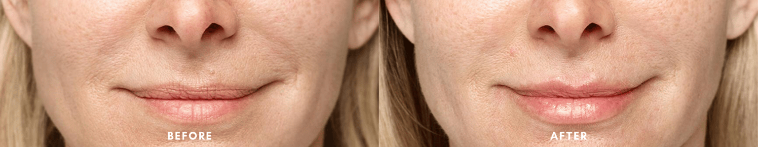 Lip Filler Healing Process Day-by-Day: A Timeline of What to Expect