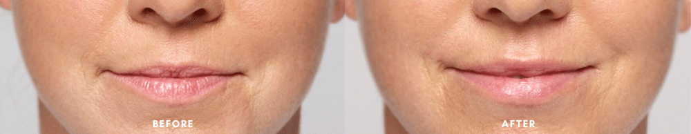 Lip Filler Healing Process Day-by-Day: A Timeline of What to Expect