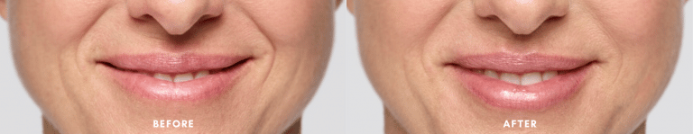 Lip Filler Healing Process Day-by-Day: A Timeline of What to Expect